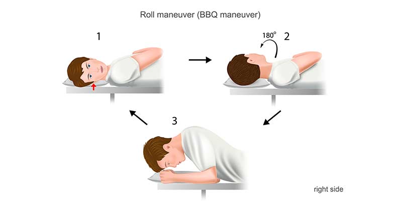 Horizontal Canal BPPV: Diagnosis and Treatment