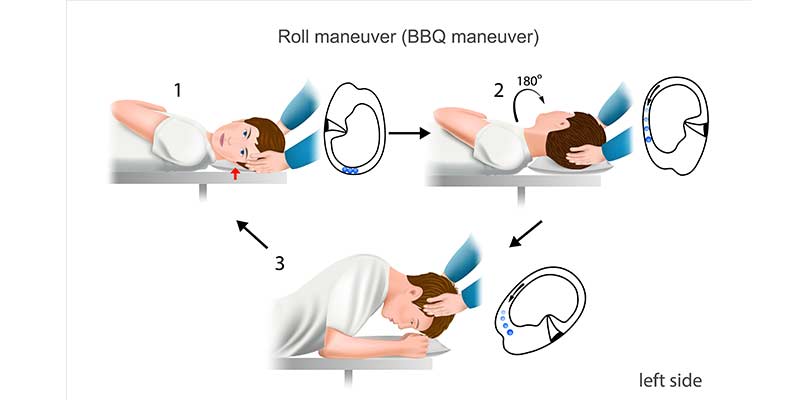 Horizontal Canal BPPV: Diagnosis and Treatment