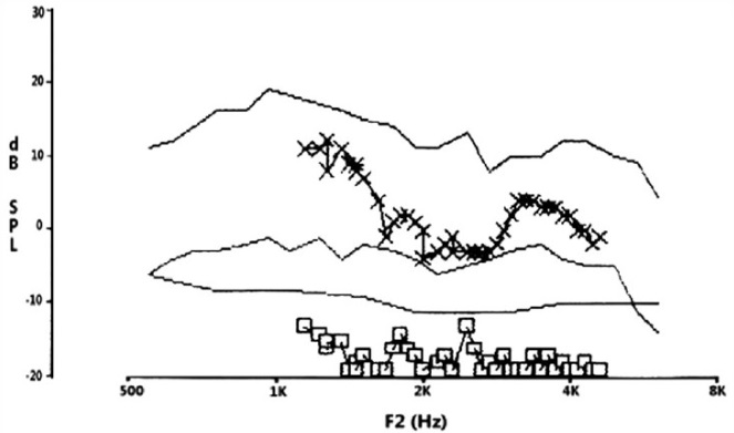 OtoAcoustic Emissions and the Standard Audiological Test Battery
