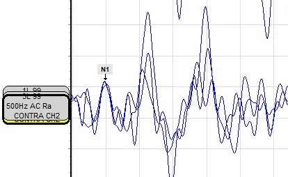 Practical Ocular Vestibular Evoked Myogenic Potential (oVEMP) Testing