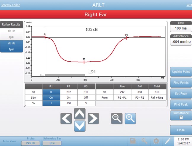 Acoustic Reflex Test | Testing Guides