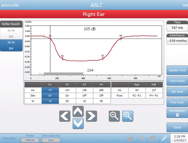 Acoustic Reflex Test | Testing Guides
